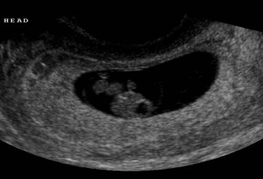Week 8 Of Gestation