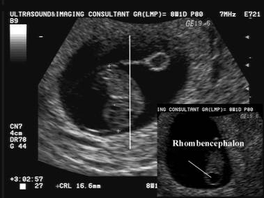 Week 8 Of Gestation