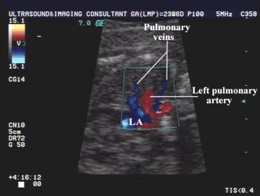 Pulmonary Veins