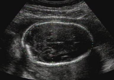 Scaphocephaly