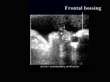 Flattened Posterior Fossa