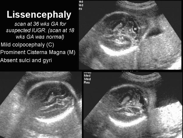 Ultrasound in Lissencephaly