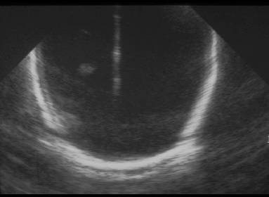 Hydranencephaly And Porencephaly
