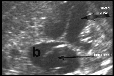 Fetal Ureter, Bladder And Urethra