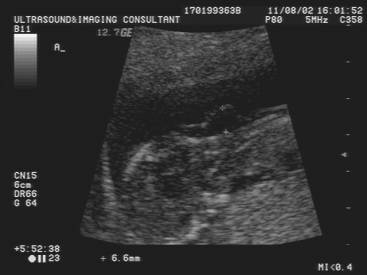 Twin-Twin Transfusion Syndrome (TTS)
