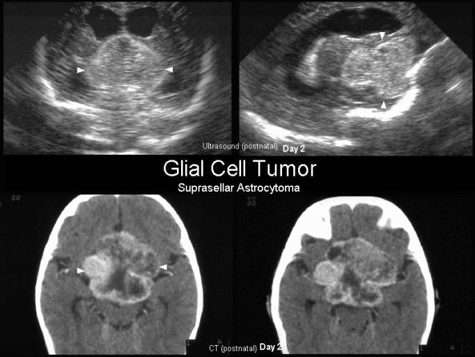 Brain Tumors Glial Cells Glioma Brain Tumors