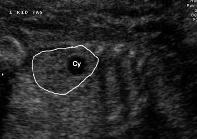 Classification of Cystic Renal Disease